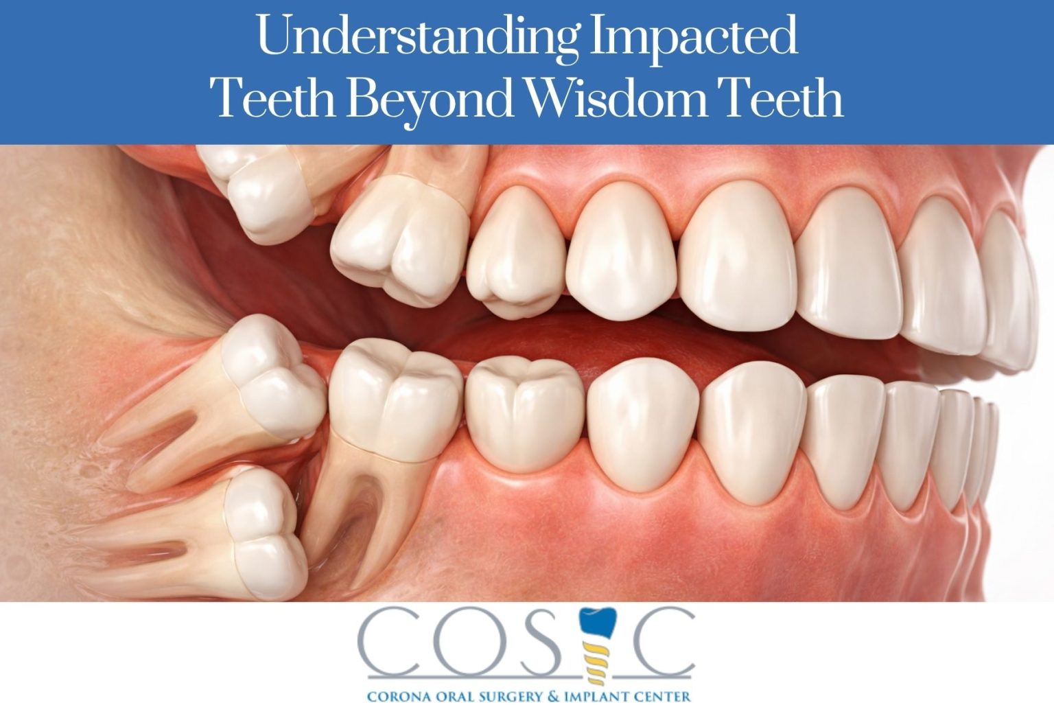 “Understanding Impacted Teeth Beyond Wisdom Teeth - Corona Oral Surgery ...
