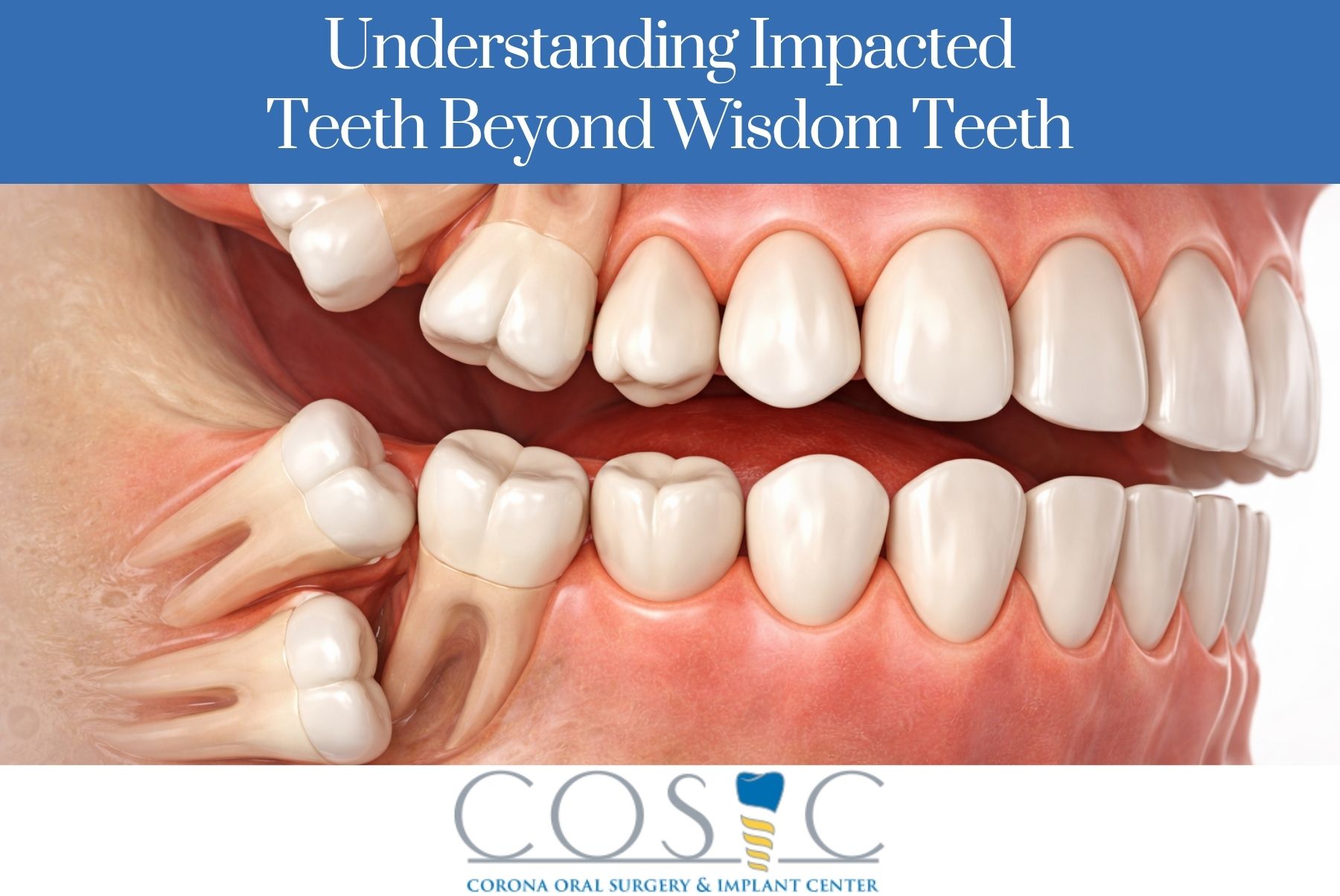 “Understanding Impacted Teeth Beyond Wisdom Teeth - Corona Oral Surgery ...